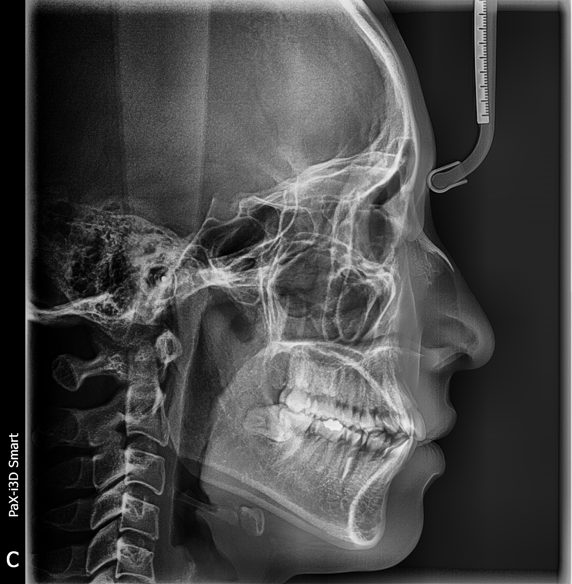 Smart 8×8 Scan Ceph – Panoramique 3D Céphalo VATECH – Synergy Dental